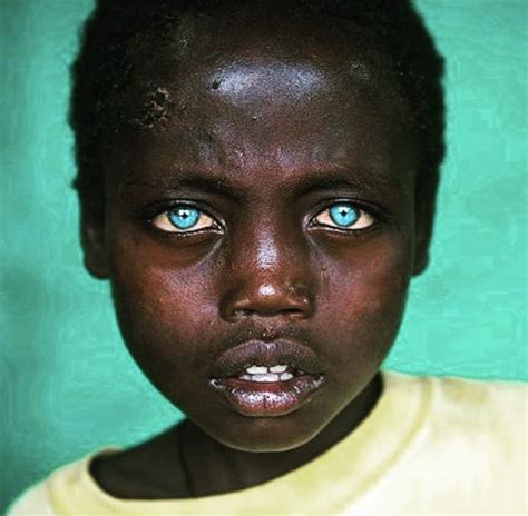 Waardenburg Syndrome Skin