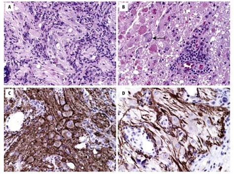 Glial And Glioneuronal Tumors Ppt Download