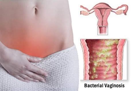 Bacterial Vaginosis Causes Symptoms Diagnosis And Bacterial Vaginosis