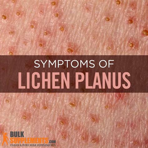 Lichen Planus Symptoms Causes And Treatment By James Denlinger