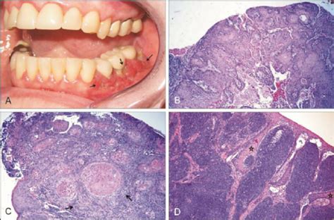 Gingival Squamous Cell Carcinoma Presenting As Periodontal Lesion In