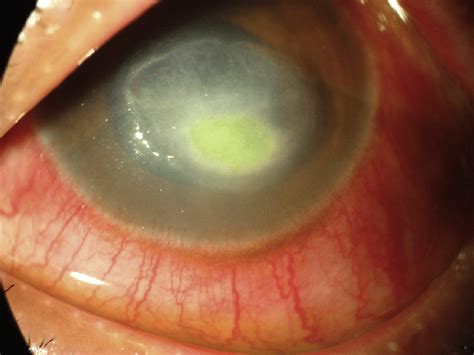 Pseudomonas Aeruginosa Keratitis Showing Diffuse Corneal Infiltrates