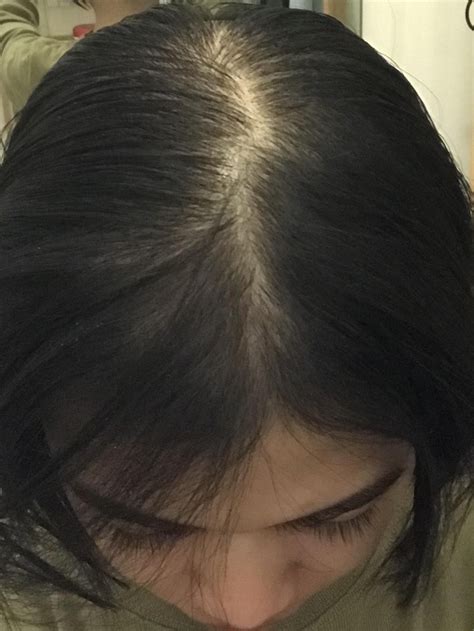 [beforeandafter] My Cystic Acne Journey R Skincareaddiction