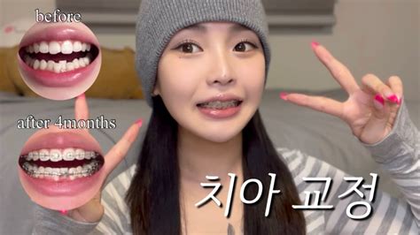 교정 4개월차 교린이의 치아 교정 후기😁 계기 병원 가격 통증 음식 관리법 Youtube
