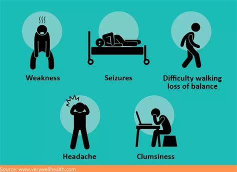 Glioblastoma –symptoms Causes Diagnosis And The Best Treatment Dr