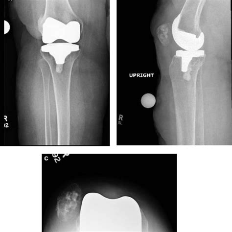 Preoperative Anteroposterior Ap A And Lateral B Radiographs