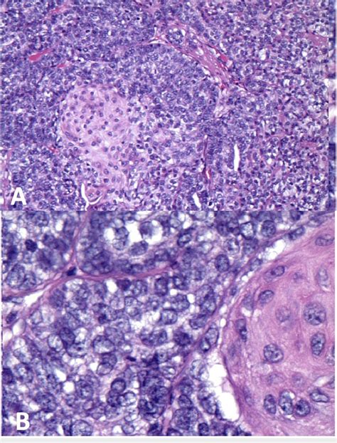 A Section Reveals Loss Of The Dual Cell Population With The
