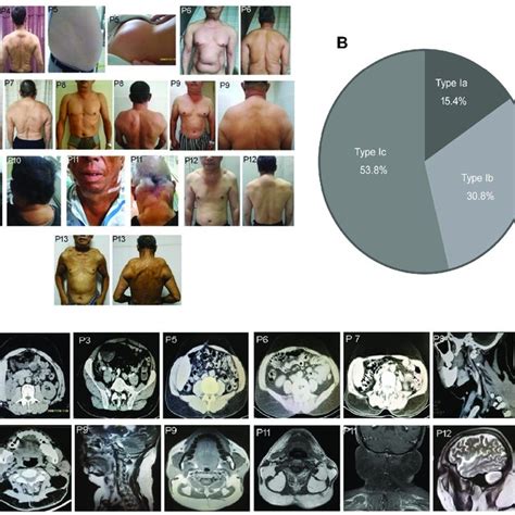 Distribution Of The Msl Adipose Tissues And Image Examinations A