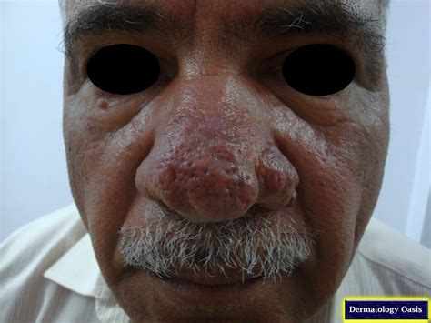 Acne And Rosacea Dermatology Oasis