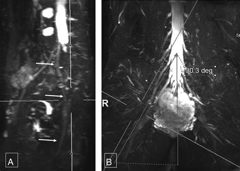 3d Mr Neurography Of The Lumbosacral Plexus Obtaining Optimal Images
