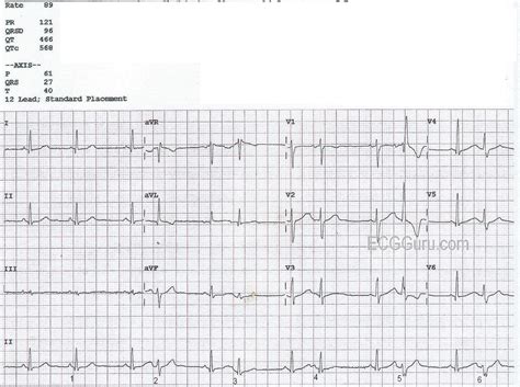 Bigeminal Rhythm With Aberrant Conduction Ecg Guru Instructor Resources