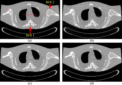 Figure 1 From Iterative Image Reconstruction For Low Dose X Ray Ct
