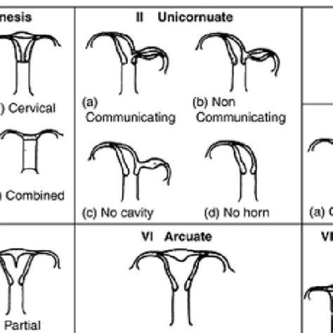 Classification System Of Müllerian Duct Anomalies Developed By The Afs
