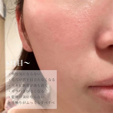 ダーマスキンピーリング｜bqcellの効果に関する口コミ「 Bqcell ⁡ ダーマスキンピーリング 」 By Hana Mo 乾燥肌