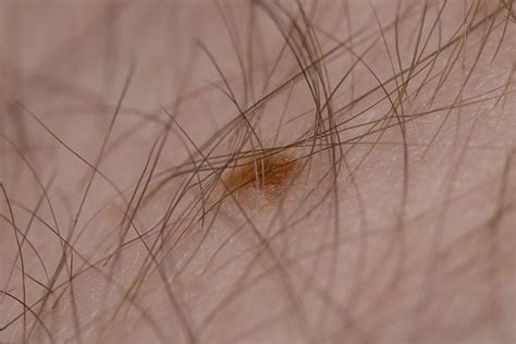 How To Know When Your Moles Are Becoming Cause For Concern