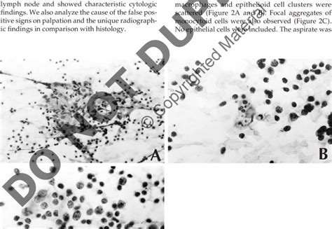 Cytologic Findings In Tl A Epithelioid Cell Cluster On A Background