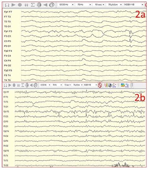 Figur 2a B Epileptiform Abnormalities On The Frontal Regions With
