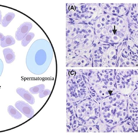 The Different Locations Of A Cryptorchid Testis Illustration Of Normal