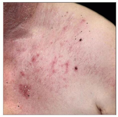 Skin Cancer Metastasis