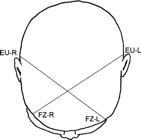 Anthropometric Measurement For Cranial Vault Asymmetry Cva