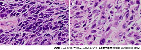 Primary Squamous Cell Carcinoma With Sarcomatoid Differentiation Of The