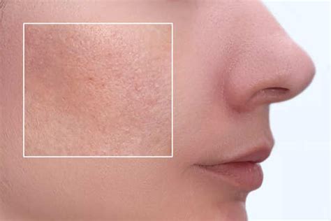 Skin Care How To Treat Clogged Pores In Winter Times Of India