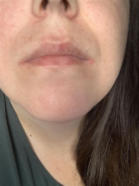 Recurring Angular Cheilitis Help R Skincareaddictionuk