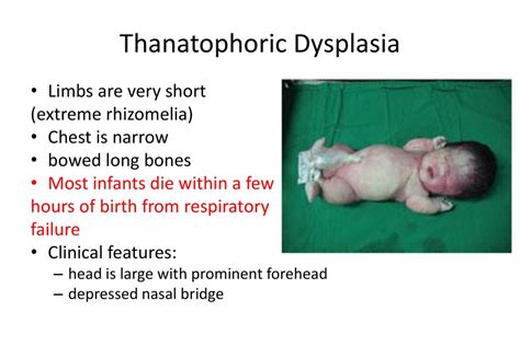Skeletal Dysplasias Ppt Download