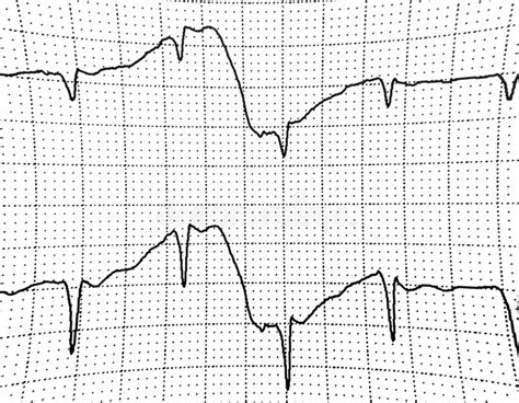 electrocardiogram test that shows electrical activity of the heart