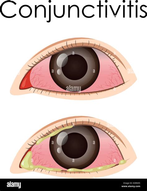 Vectores De Conjuntivitis Vector Fotografías E Imágenes De Alta