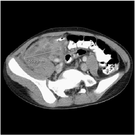 Laparoscopic Drainage Of Intraabdominal Abscess After Appendectomy An