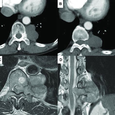 A And B Computed Tomography Of The Chest Images In The Axial Plane