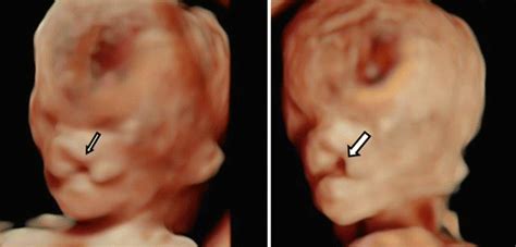 Evaluation Of The Fetal Face In The First Trimester Radiology Key