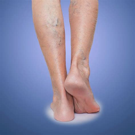 Treatment Options For Varicose Veins Midwest Radiology
