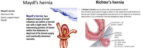 Maydls Hernia And Richters Hernia