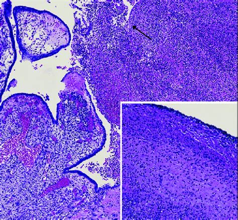 A 44 Year Old Woman With Uterine Fibroids Status Postuterine Artery