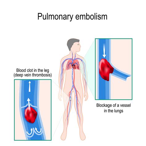 Pathophysiology Pulmonary Embolism