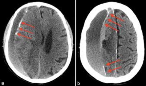 Microstructure Of Embolized Capsule Of Chronic Subdural Hematoma