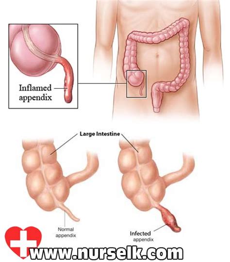 Appendicitis
