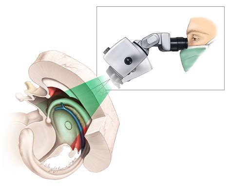 Posterior Interhemispheric Transcallosal Intervenous Paravenous Variant