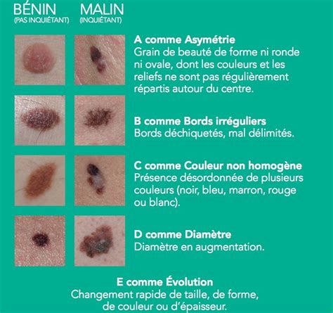 Mélanome Comment Reconnaître Un Grain De Beauté Suspect