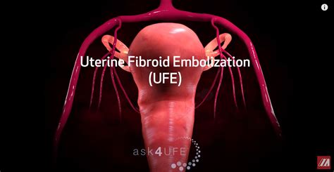 Uterine Fibroid Embolization An Alternative To Hyster