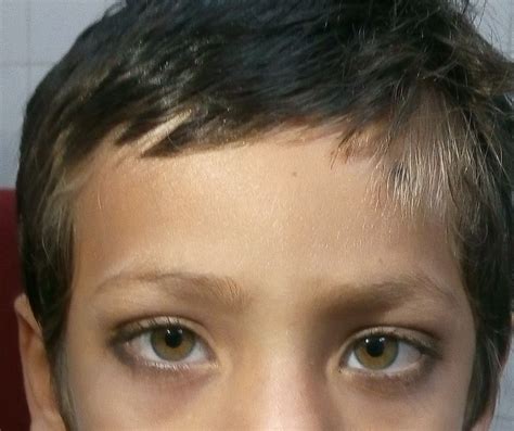 White Lock Of Hair With Heterochromia Waardenburg Syndrome