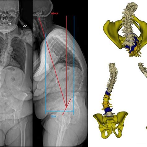 Global Spinal Sagittal Alignment Parameters Sva C7 Tilt Tpa T1spi