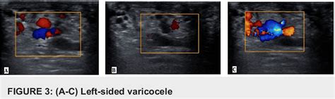 [pdf] Evaluation Of Scrotal Pathologies By Ultrasound And Color Doppler