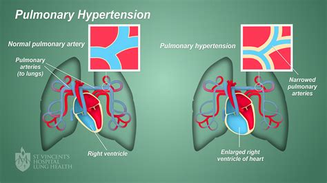 5 Types Of Pulmonary Hypertension