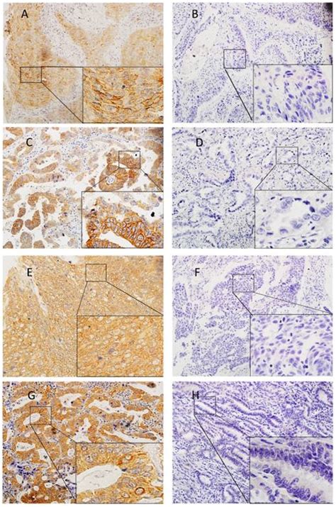 pd l1 is a prognostic biomarker in resected nsclc patients with
