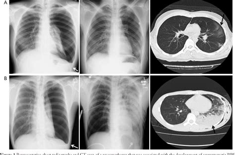 Pleural Effusion Vs Pneumothorax