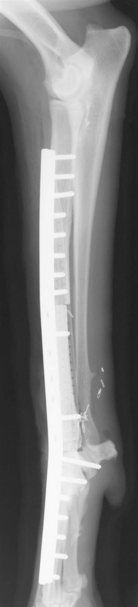 Bone Tumors Appendicular Dr Julius Liptak