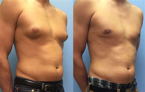 Gynecomastia Common Causes And Treatment Options Healthiest